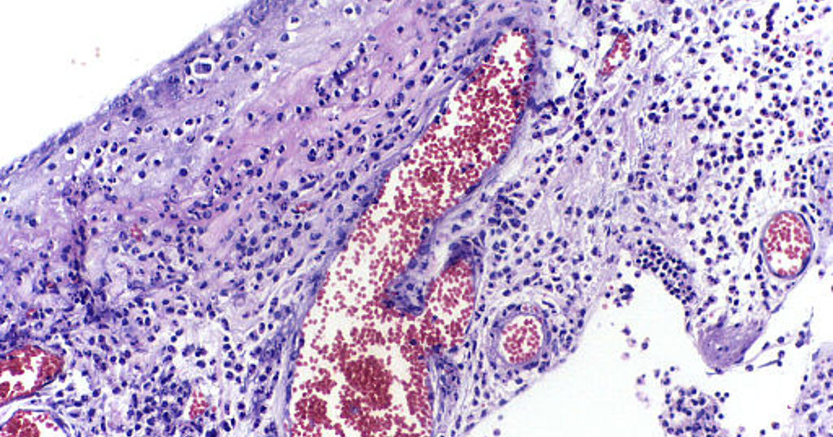 Optimal Control Methods to Analyze Acute Inflammation | SIAM