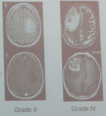 Radiotherapy and Pregnancy in the Presence of Low-Grade Gliomas | SIAM