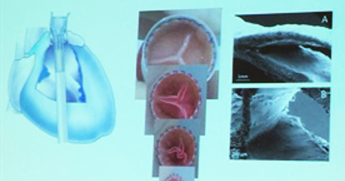 Computationally Modeling Tissue-Engineered Heart Valves | SIAM