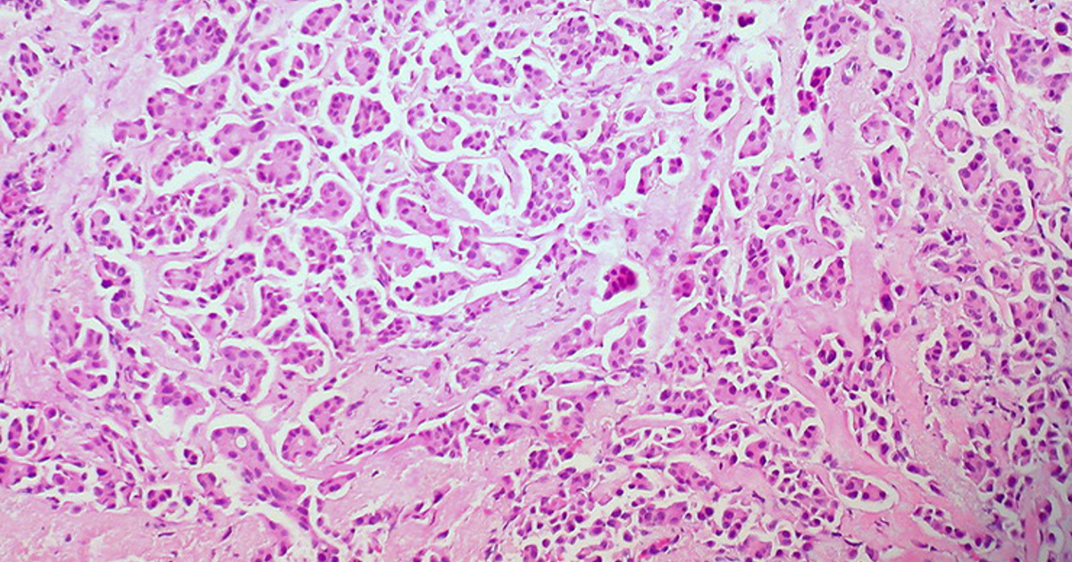 Multistage Clonal Expansion Model Examines Early-onset Cancer Incidence ...