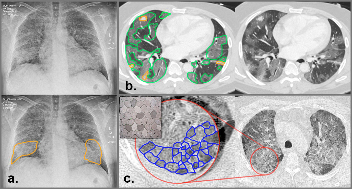 Fighting a Pandemic with Medical Imaging and Machine Learning: Lessons ...