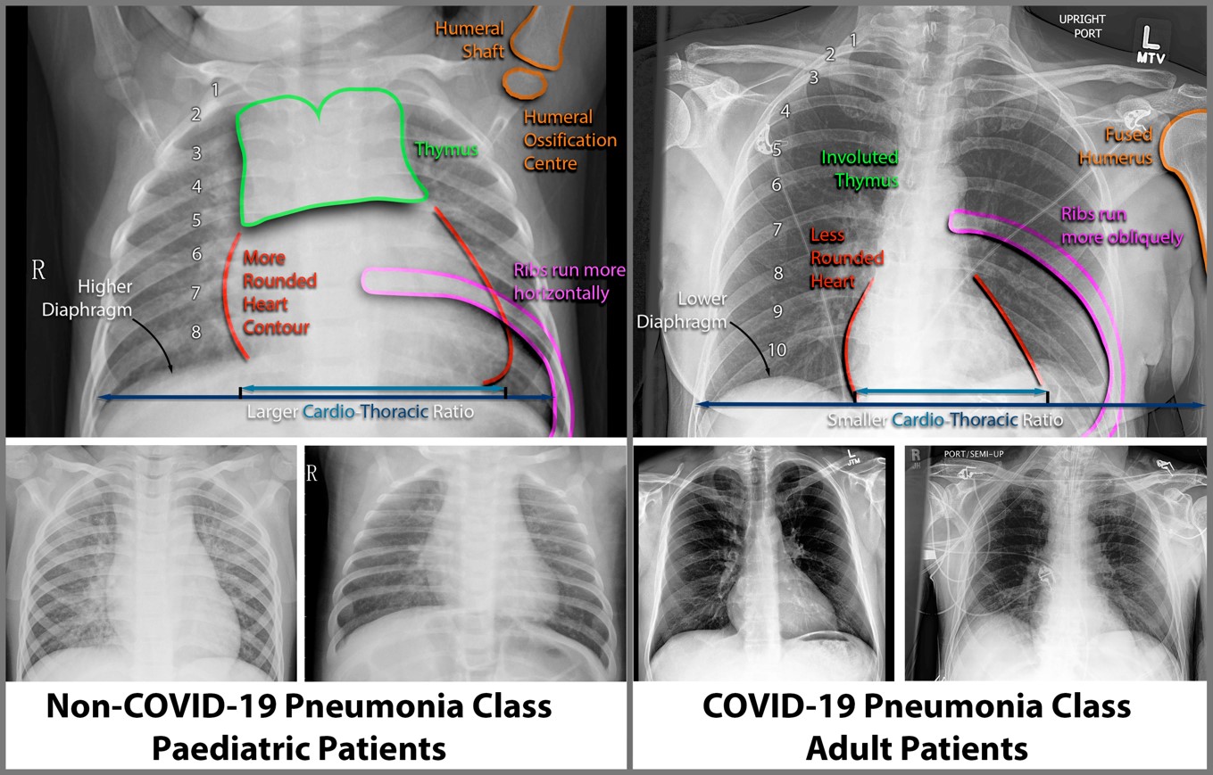 Fighting a Pandemic with Medical Imaging and Machine Learning: Lessons ...
