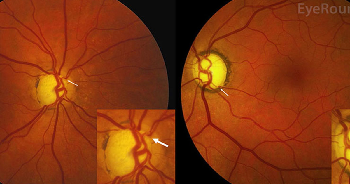 When Artificial Intelligence Takes Shortcuts, Patient Needs Can Get ...