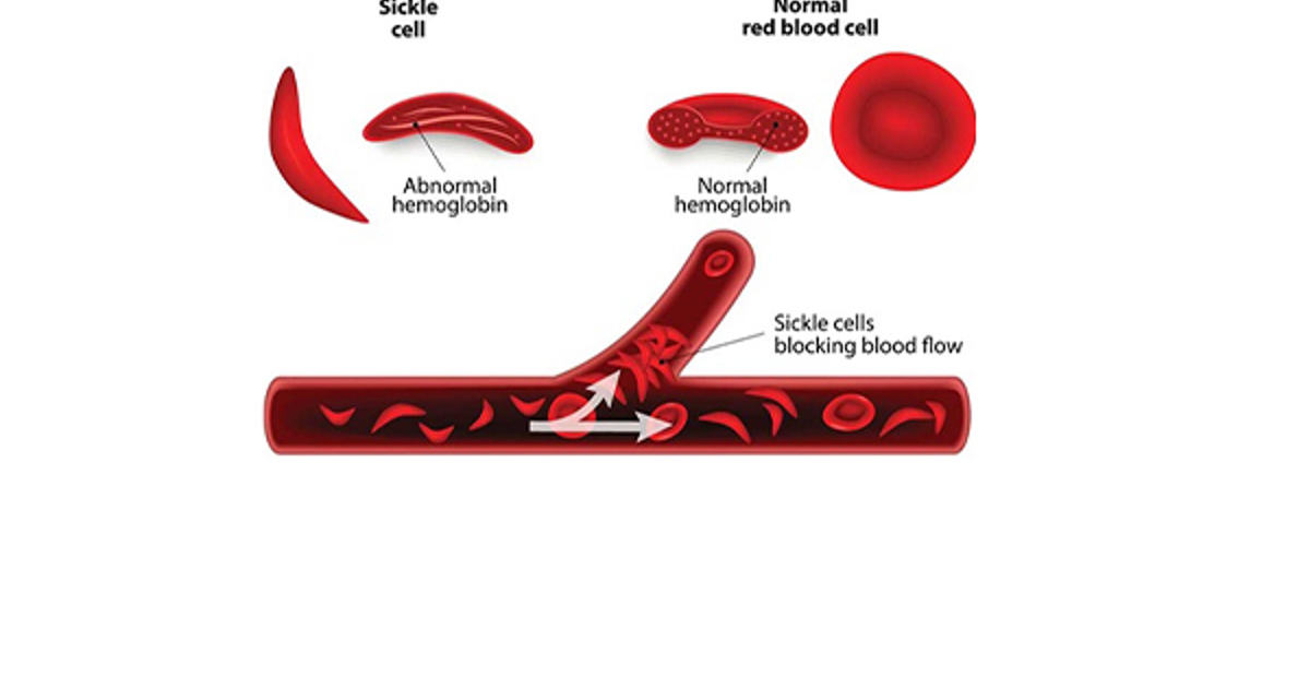 Novel Mathematical Framework Models Pediatric Sickle Cell Pain and ...