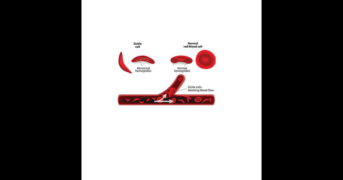 Novel Mathematical Framework Models Pediatric Sickle Cell Pain and ...