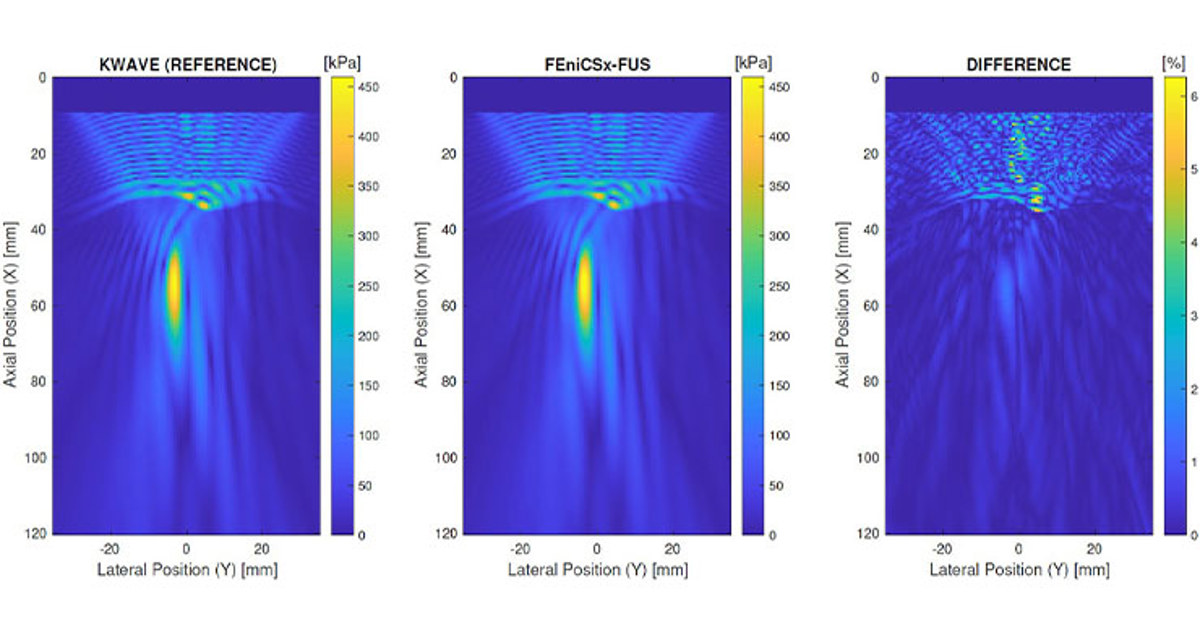 A Fast Finite Element Solver for Focused Ultrasound Applications | SIAM