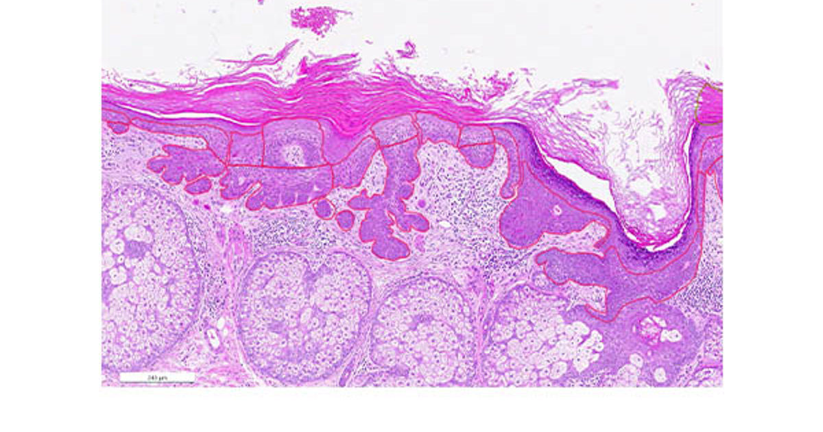 Deep Learning for Digital Pathology: Detecting Skin Diseases with ...