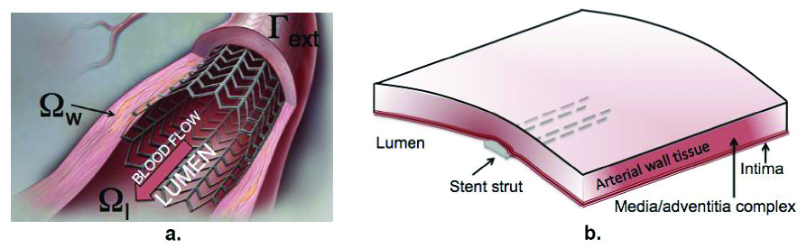 New Mathematics for Next-Generation Stent Design | SIAM